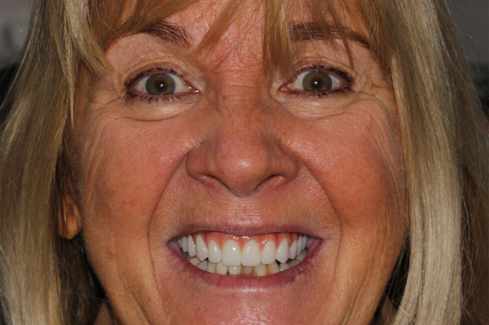 Smile Gallery | Before & After Treatment | Cosmetic Dentist Bromley